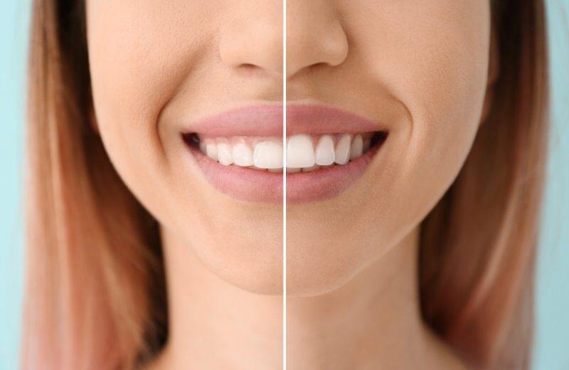 teeth-seem-too-small-and-shrinking